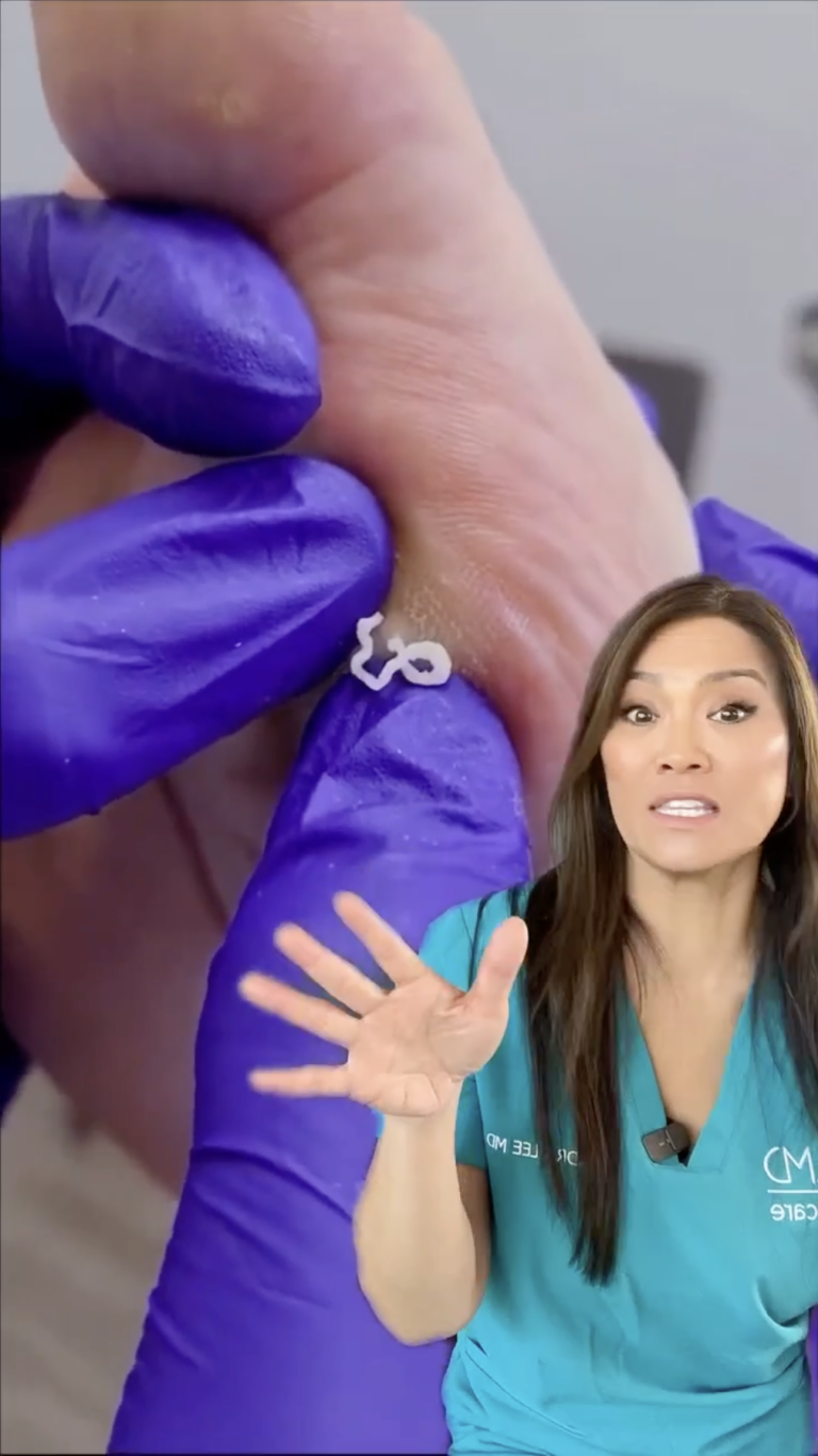 Dr Pimple Popper — 'Parmesan Cheese' Noodles Scraped Off Feet