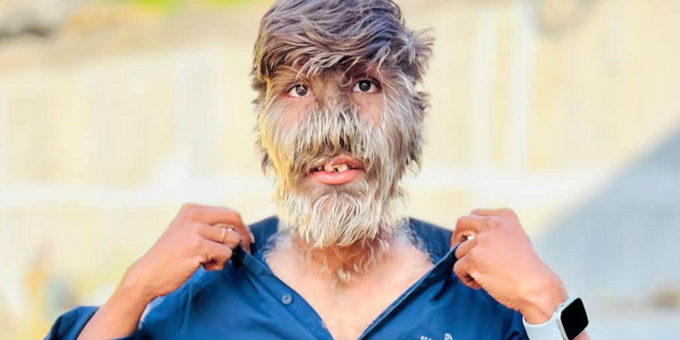 Teen Sets Guinness World Record Thanks To ‘Werewolf Syndrome’