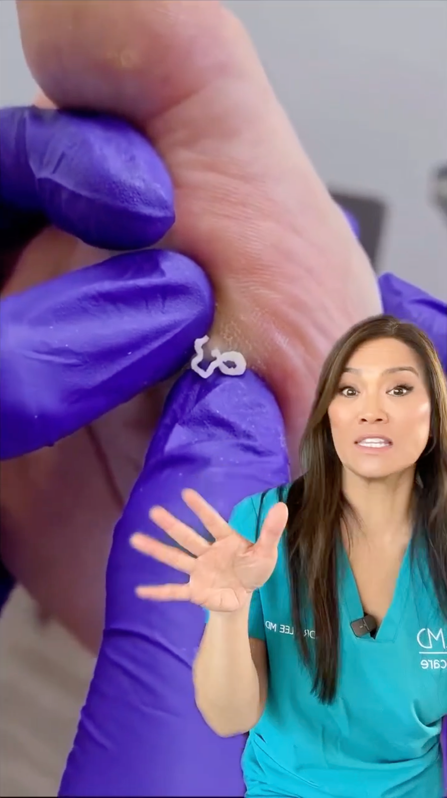Dr Pimple Popper — 'Parmesan Cheese' Noodles Scraped Off Feet