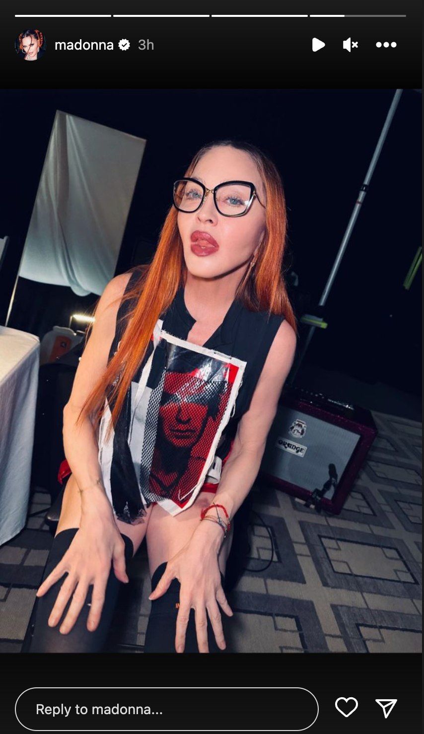 Madonna Seen With Thigh Bruise Amid Celebration Tour Rehearsal