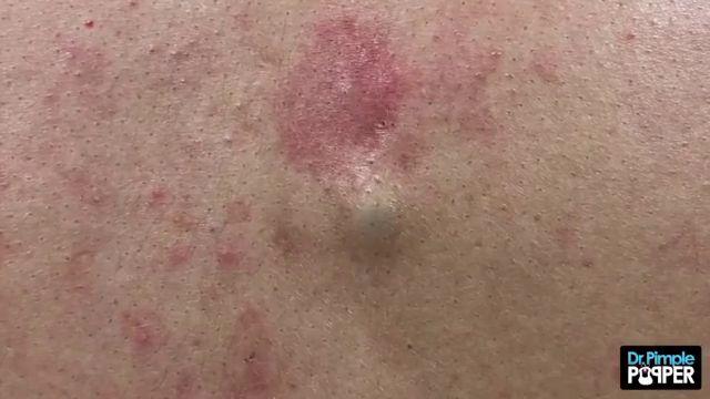 Dr. Pimple Popper - Shocking Video Of An 'Abscess Waterfall'...You Have ...