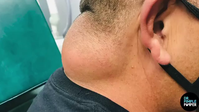 Dr. Pimple Popper - Watch This HUGE Neck Cyst Pulled Out Like A Baby ...